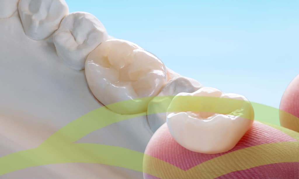 Goodbye Tooth Troubles: Dental Crowns Can Save the Day