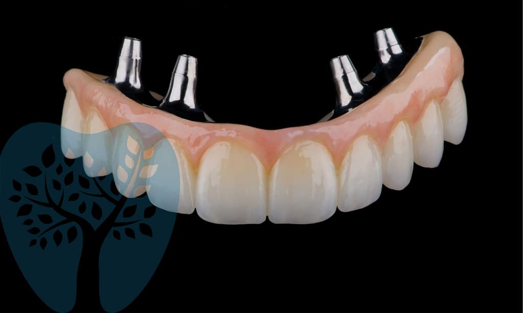 Full Mouth Dental Implants: Tooth Replacement Solution