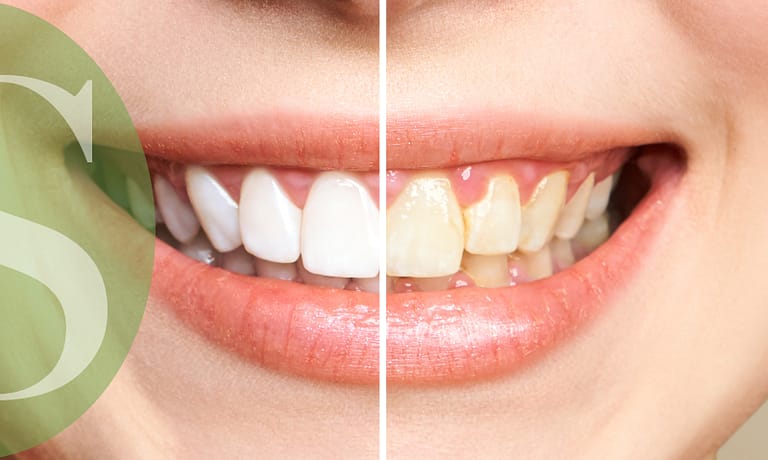 Help, I Have Yellow Teeth! What Can I Do About It?