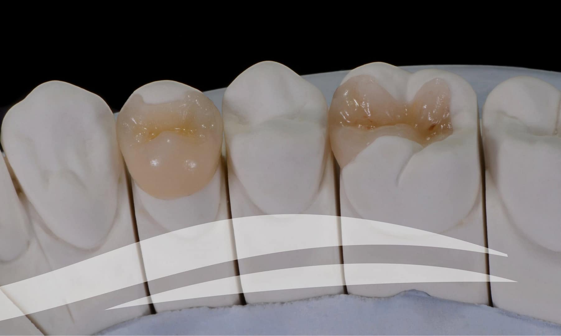 Tooth Restoration: The Magic Behind Inlays and Onlays