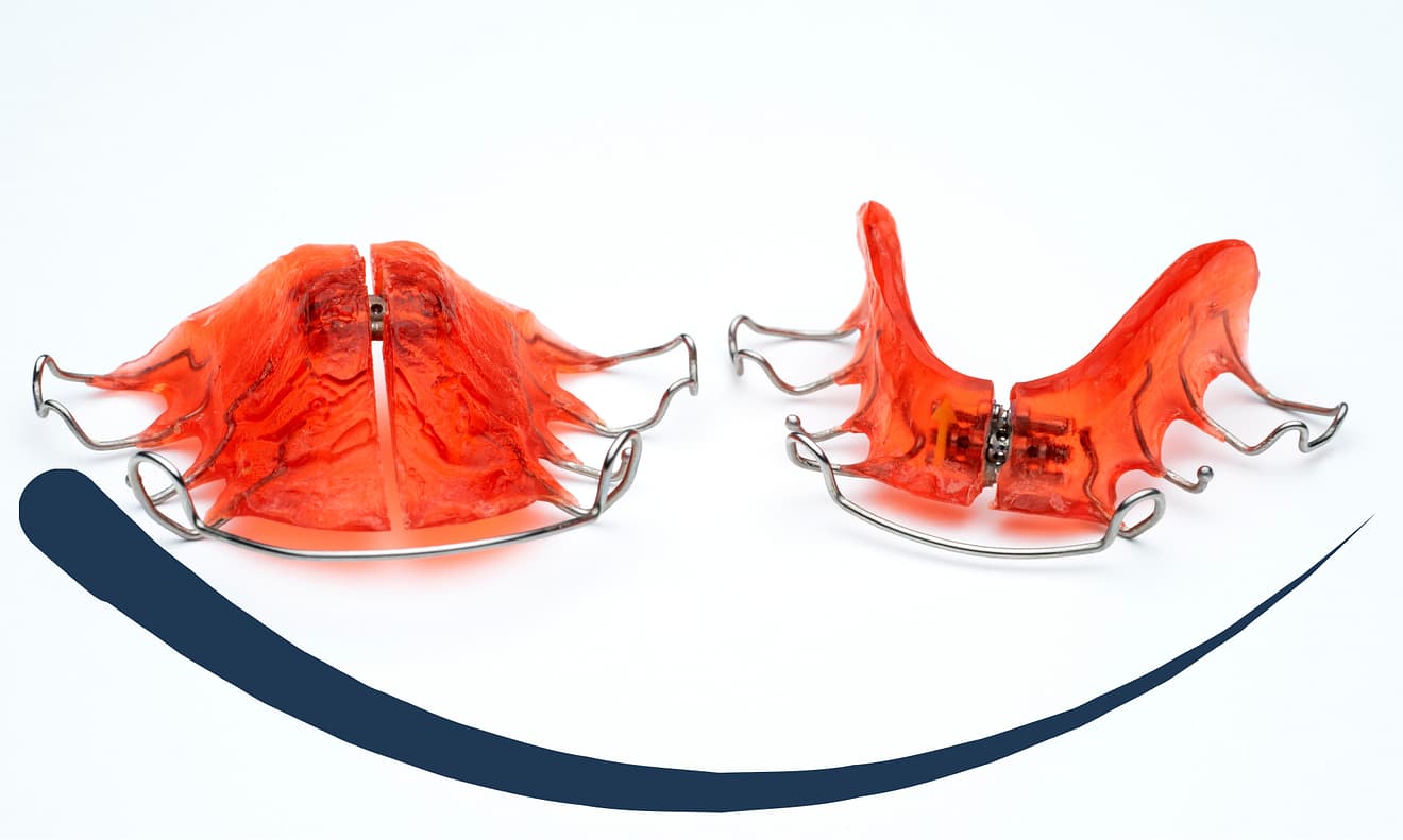 Palatal Expanders: Purpose, Candidates, and Timeline