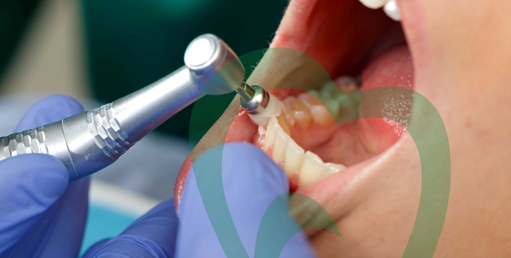 Plaque vs. Tartar: What’s the Difference, Learn Prevention